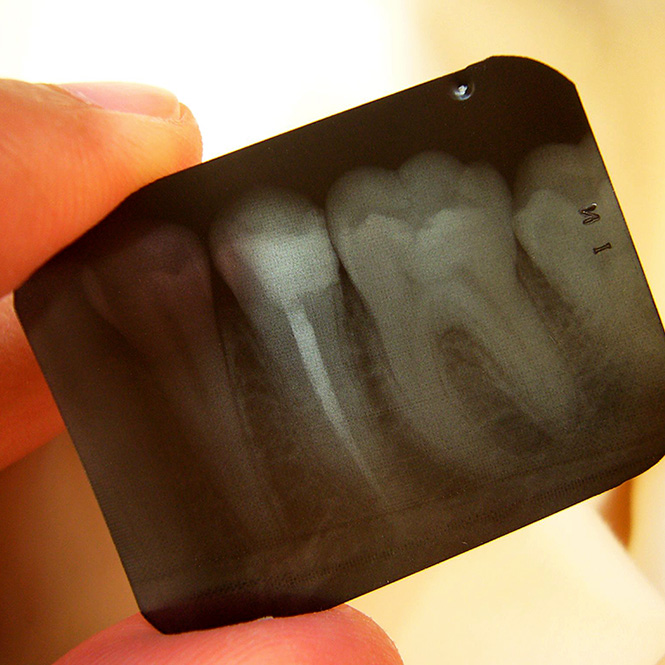 See The Full Picture On Dental X-Rays – Pendleton IN | Sisson Family ...